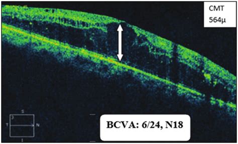 Preoperative Optical Coherence Tomography Image Of A Patient With Download Scientific Diagram