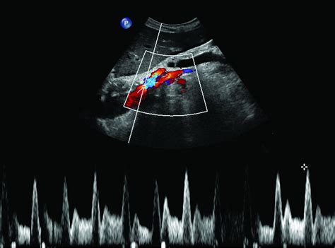 Chronic Mesenteric Ischemia Mesenteric Artery Duplex Sonography And