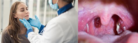 Tonsil And Adenoid Surgery Dr Murali Mahadevan Ent Surgeon