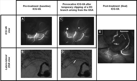 Selective Targeted Extra Intracranial Bypass Surgery In Complex Middle