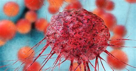 Gastrointestinal Stromal Tumor Gist Bayer Ag Bayer Global