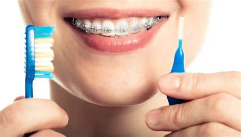 Dental Braces Care Tips