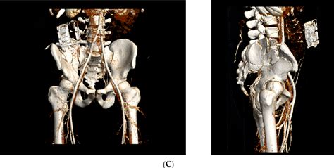 Figure 1 From Application Of Pelvic Circumferential Compression Devices In Pelvic Ring Fractures