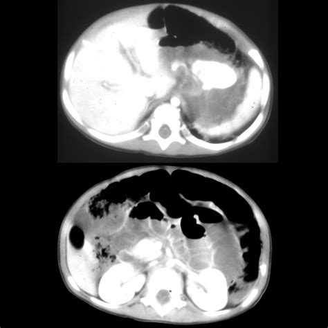 Hypoperfusion Complex Pediatric Radiology Reference Article Pediatric Imaging Pedsimaging