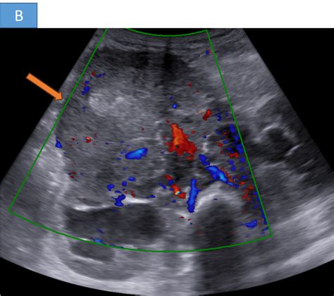 A 7 Month Old Infant Presented With Complaints Of Abdominal Distension