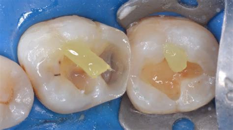 A Recipe For Class Ii Composite Restoration Myzerodonto