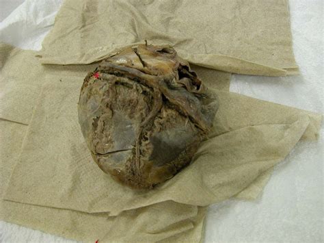 Interventricular Sulcus And Septum Interventricular Sulcus And Septum