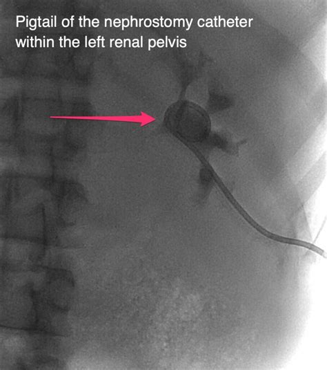 Nephrostomy Location