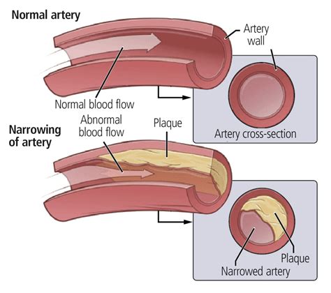 Blood Pressure Arterial Occlusion At Michael Robin Blog