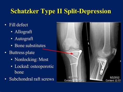 Proximal Tibia Fractures And Its Management Pptx Proximal Tibia Fractures And Its Management Pptx