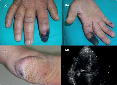 Figure 1 From A Staphylococcus Aureus Endocarditis Presented With Skin