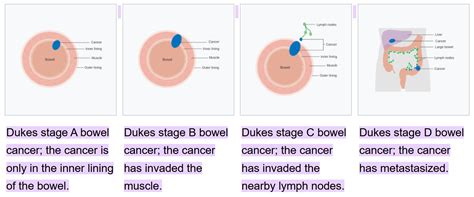 Anal Cancer Staging