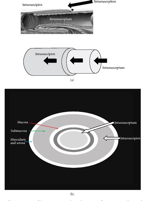 Figure 1 From Intussusception After Laparoscopic Gastric Bypass Surgery An Underrecognized