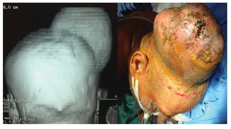 Resección De Dermatofibrosarcoma Protuberante Recurrente Con Injerto Fasciomiocutáneo