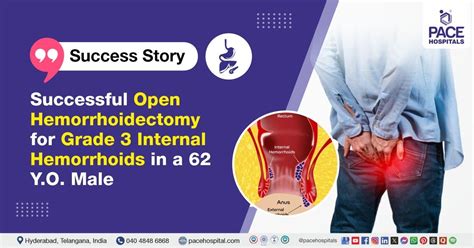 Grade 3 Internal Hemorrhoids Treated With Open Hemorrhoidectomy