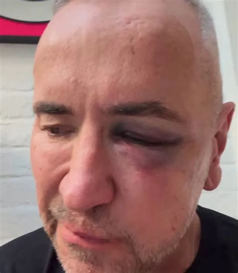 Dj Fat Tony Reveals Horrific Facial Injuries After Attack And Rushed To
