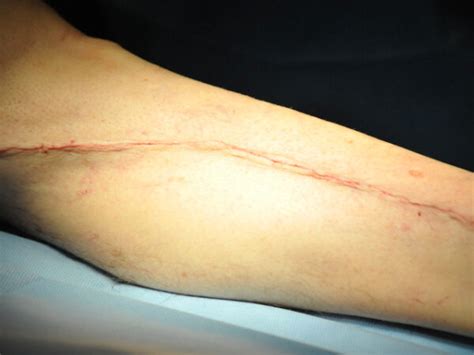 Femoral Tibial Vein Bypass With Saphenous Vein Vascular And Vein