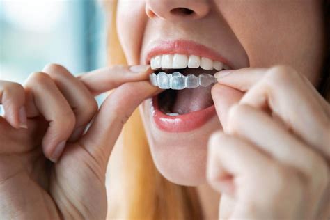 How To Effectively Clean Invisalign Aligners Editorialge