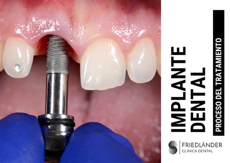 Implantes Dentales Proceso Completo Clínica Friedländer
