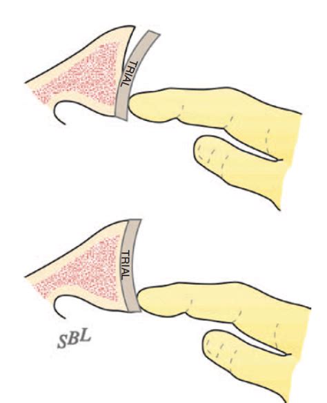 Uw Shoulder And Elbow Academy The Glenoid Component In Total Shoulder Arthroplasty Getting It