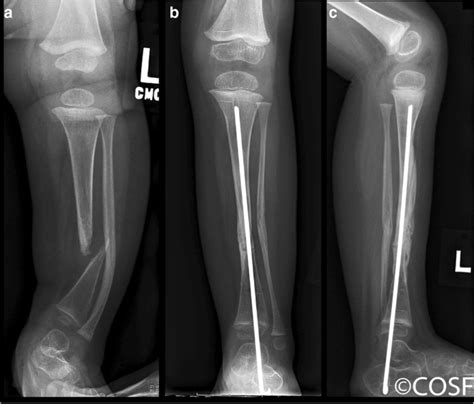 A Pre Operative Anteroposterior Radiograph Illustrating Tibial