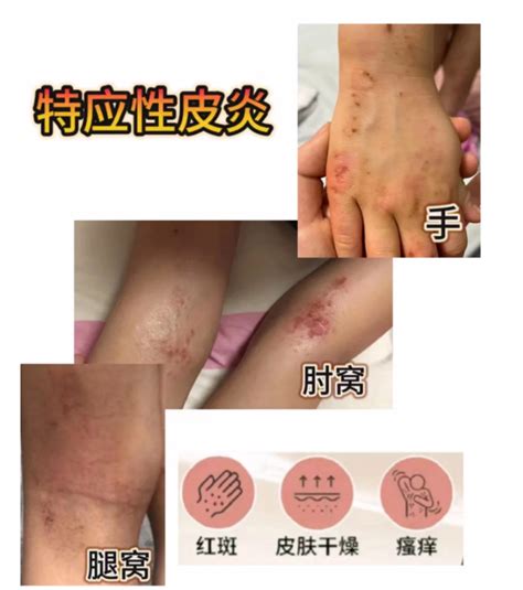 特应性皮炎，别再傻傻等自愈了 知乎