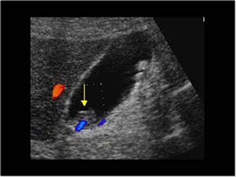 Abdomen And Retroperitoneum 1 2 Gallbladder And Bile Ducts Case 1 2 9 Gallbladder Polyps
