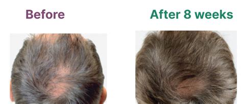 Microneedling My Bliss Clinic