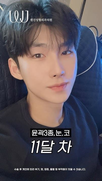 남자 윤곽3종눈코 성형 후기 Shorts Youtube