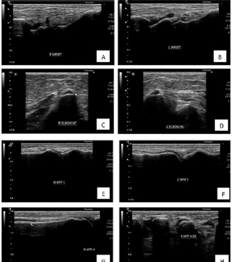 A And B Show Grade 2 Symmetric Synovitis Of Bilateral Wrists C Right