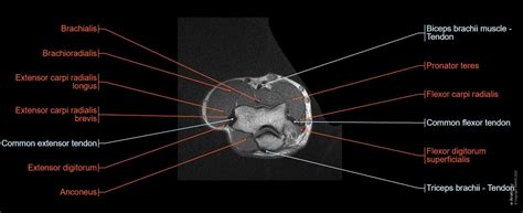 Humerus Muscle Mri Attachments Postoperative Mr Imaging Of The Rotator Humerus Muscle Mri Attachments Postoperative Mr Imaging Of The Rotator