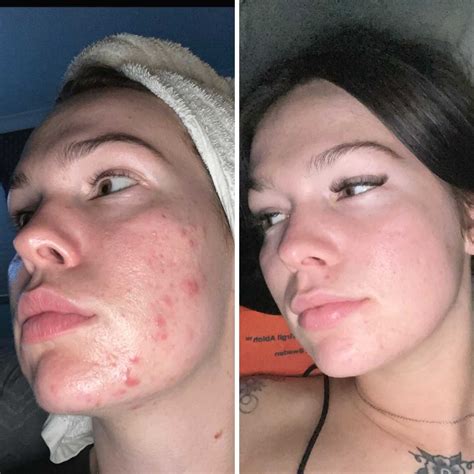 Teen Tween Trial Set For Breakout Prone Skin L Rawkanvas Rawkanvas Nz