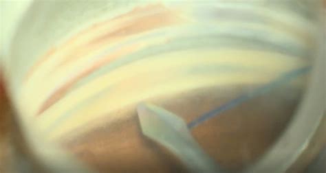 Ab Interno Trabeculectomy And Trabeculotomy Eyewiki