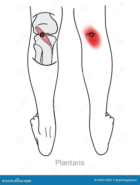 Plantaris Myofascial Trigger Points And Back Of Knee Pain Royalty Free