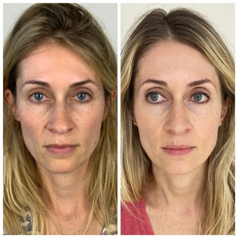 The Scoop On Sculptra The Luxe Room