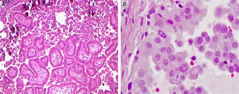 Prevalence Of A Hobnail Pattern In Papillary Poorly Differe The