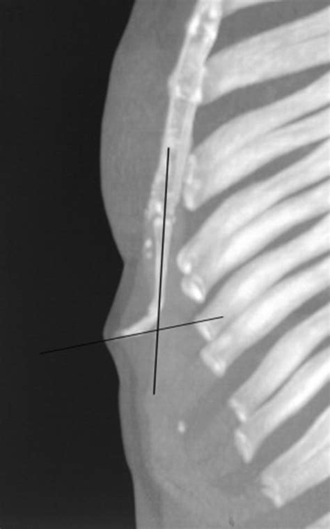 Xiphisternal Joint Injection Clinical Tree