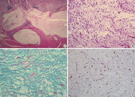 A The Tumor Demonstrates A Multinodular Plexiform Growth Pattern B Download Scientific