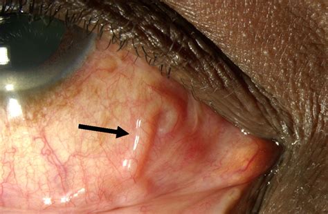 Subconjunctival Loa Loa Worm International Journal Of Infectious Diseases