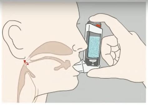 How To Use An Inhaler Correctly A Step By Step Guide For Asthma Patients Guest