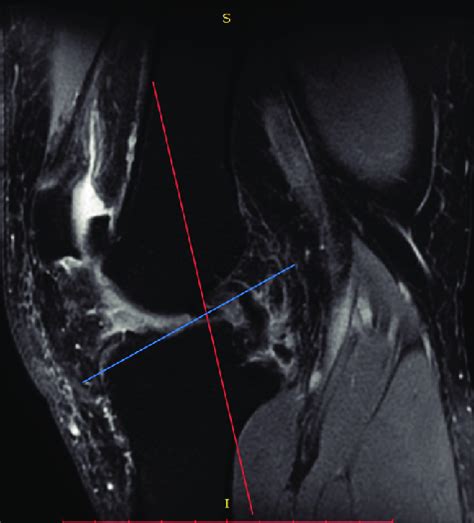 Longitudinal Tibial Axis In The Mid Sagittal Plane Download Scientific Diagram