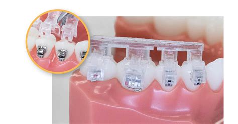 Ormco Announces The Launch Of Its Latest Innovation Ormco™ Digital Bonding Powered By Spark