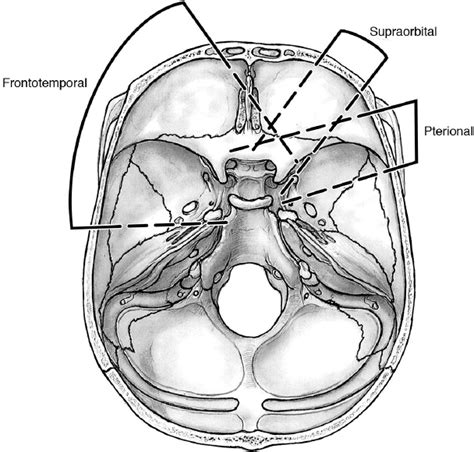 Transcranial Approaches To The Skull Base Neupsy Key