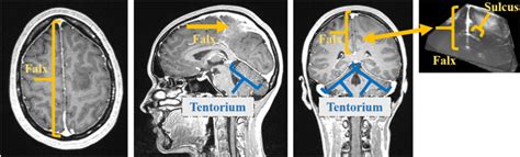 Automatic And Efficient Mri Us Segmentations For Improving
