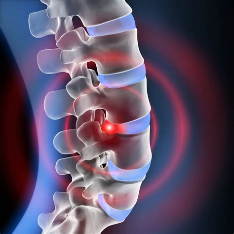Degenerative Disc Disease Definition Causes Symptoms Diagnosis And
