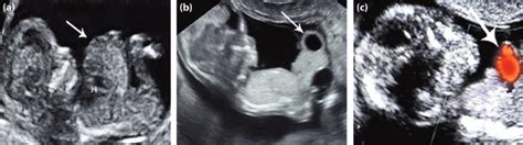 22 A Pentalogy Of Cantrell The Typically Supraumbilical Omphalocele