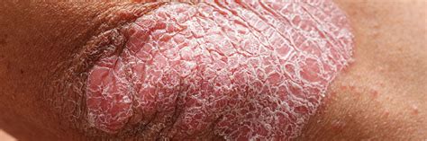 Exploring Imaging Techniques For Psoriasis Plaques