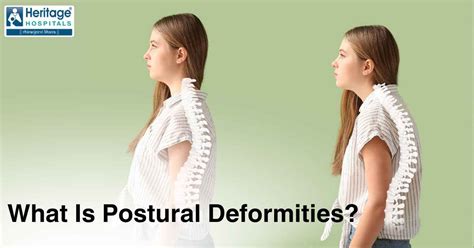 What Is Postural Deformities Causes Symptoms And Solutions