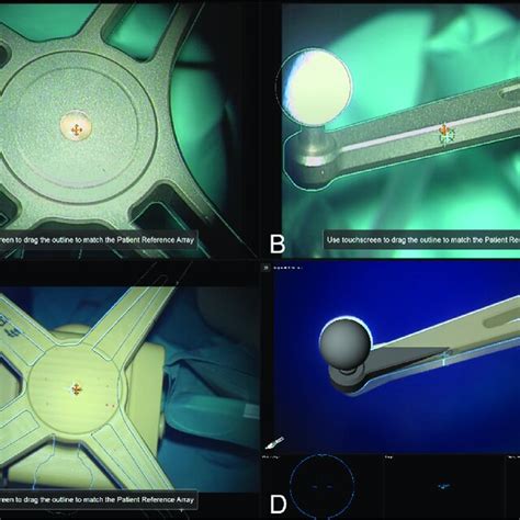 The Ar Representation Of The Cranial Patient Reference Array