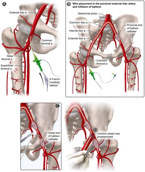 A Novel Technique For External Iliac Artery Reconstruction In Renal